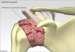 Adhesive capsulitis - Sudhir Rao - Knee Hip and Shoulder surgeon